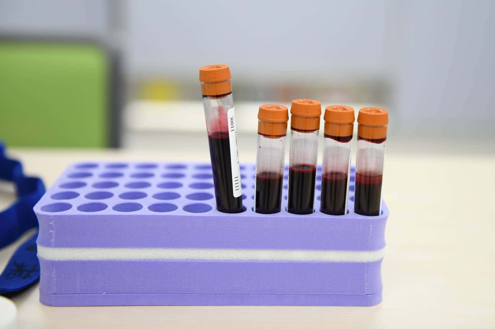 Breakthrough Alzheimer’s Blood Test Offers Early Detection and ...